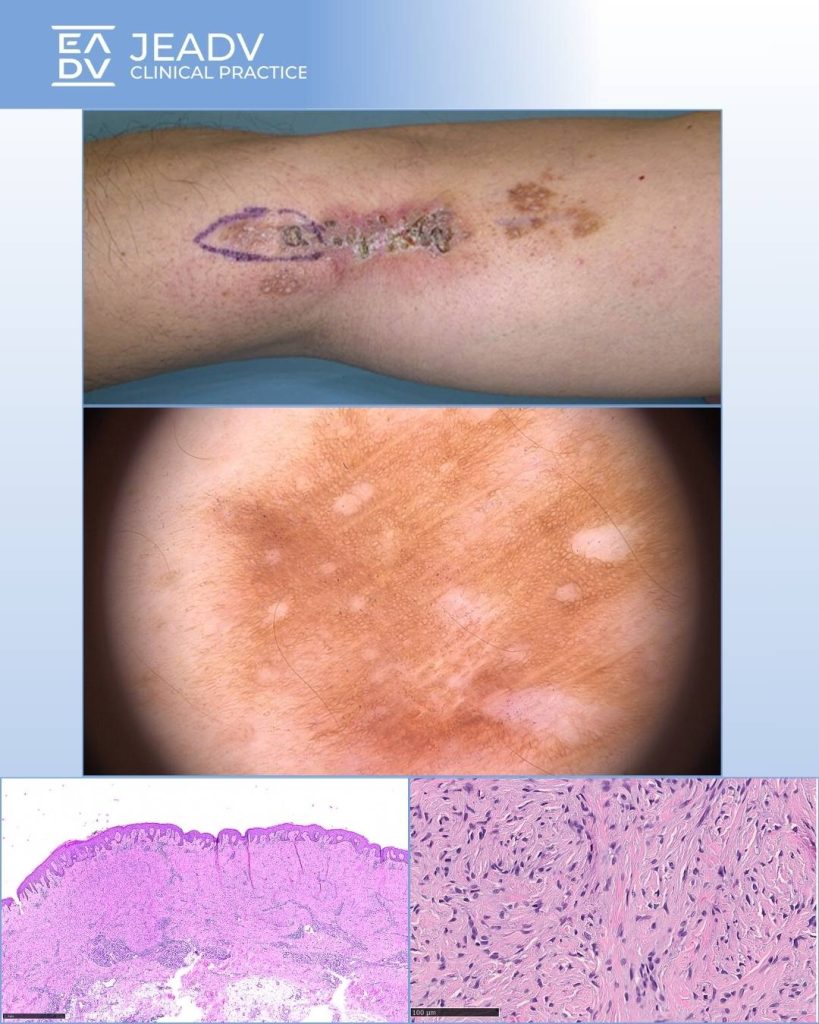 JEADV Clinical Practice | Open-access Dermatology Journal